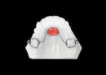 Space Maintainers | Clermont Kids Dentistry & Orthodontics, P.A.
